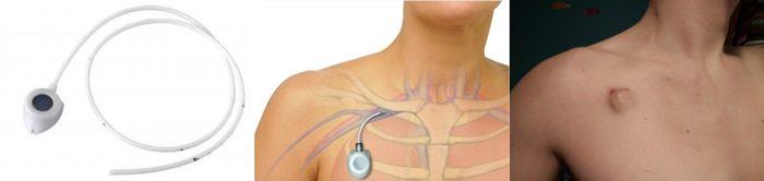 Port-A-Cath (Cateter totalmente implantado) | Oncocentro