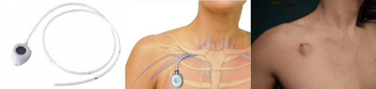 Port-A-Cath (Cateter totalmente implantado) | Oncocentro