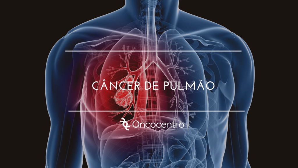 Câncer de pulmão | Oncocentro